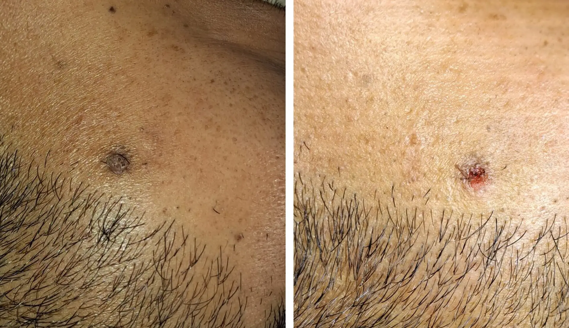 Skin Tag Wart Removal Radiofrequency treatment for skin